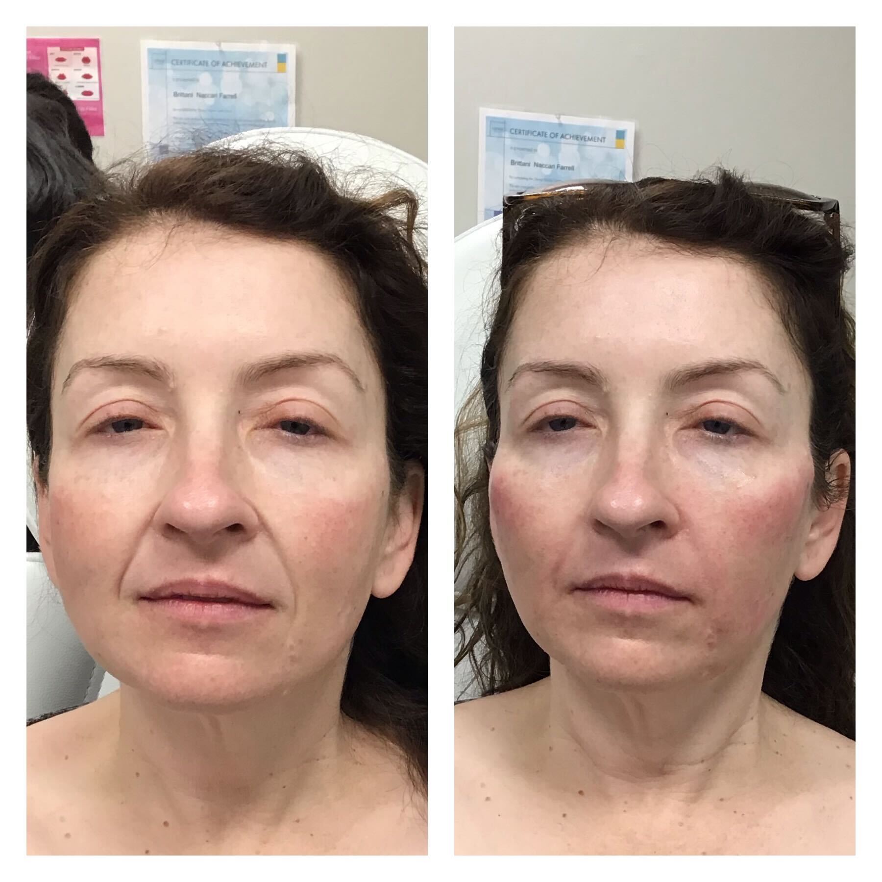 B&A #3: Liquid Face Lift | Saintly Skin