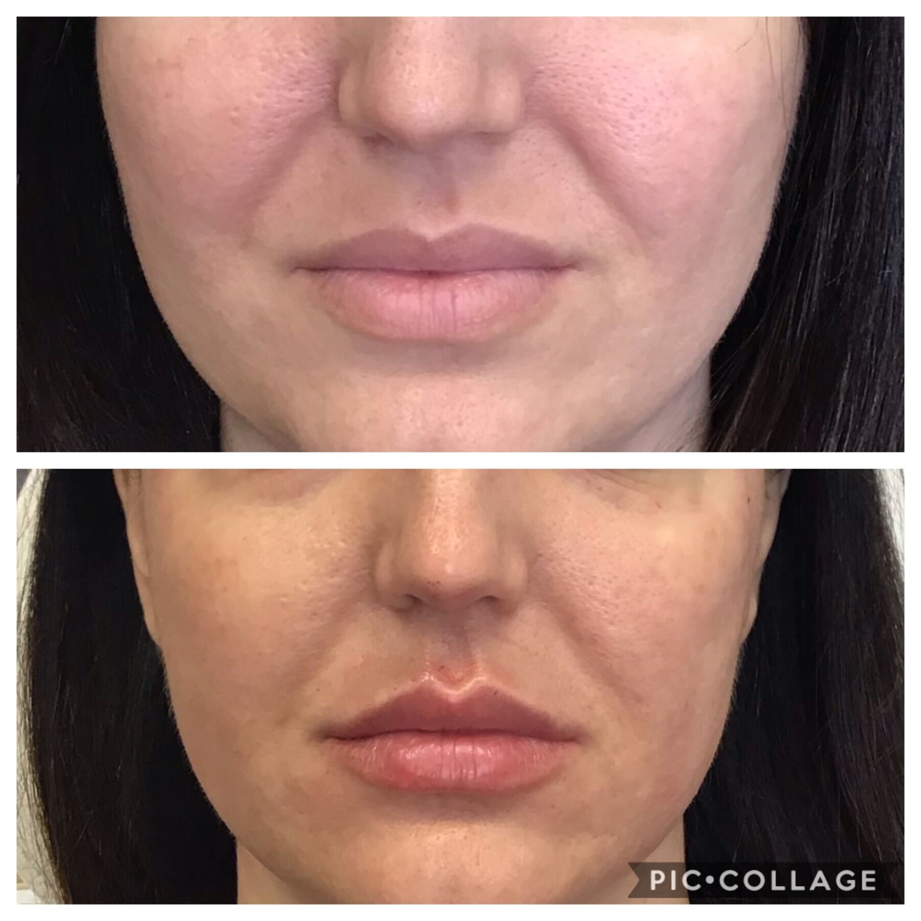 B&A 12: RHA 3 Lip Filler | Saintly Skin